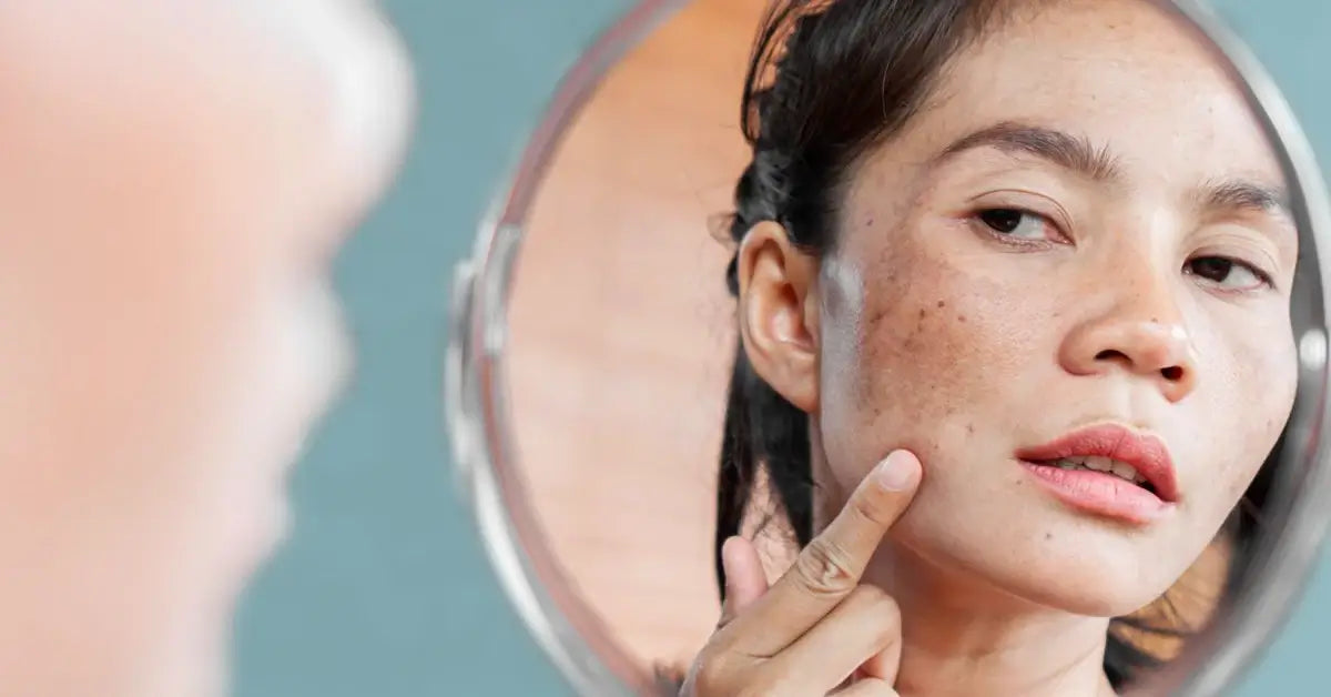Treating and Preventing Hyperpigmentation – Sabila Skincare